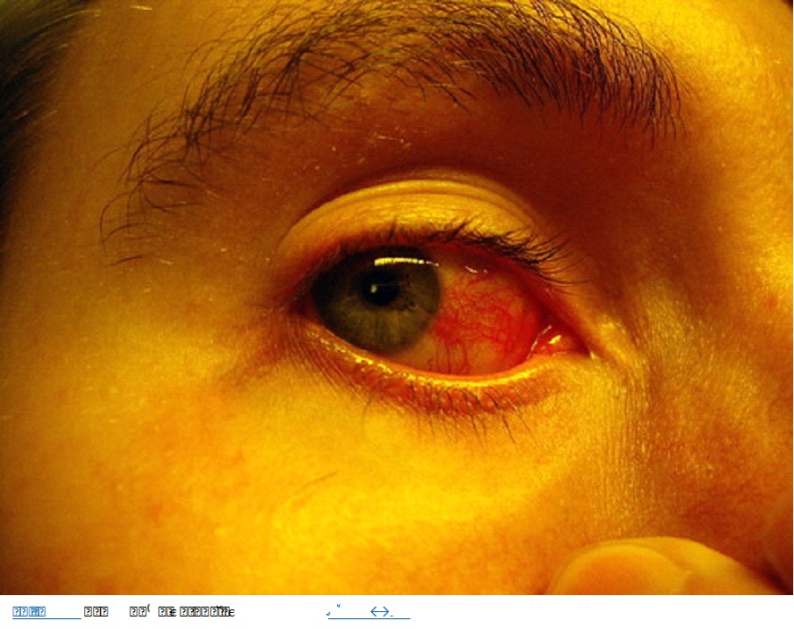 Follow basic hygiene to avoid painful pink eyes - Meghalaya Monitor